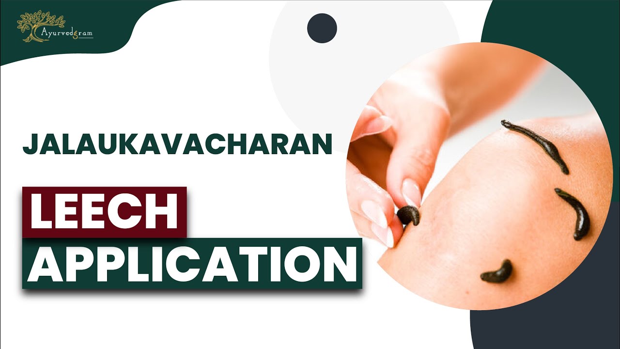 Jalaukavacharan - Leech Application Therapy | Ayurvedgram - YouTube