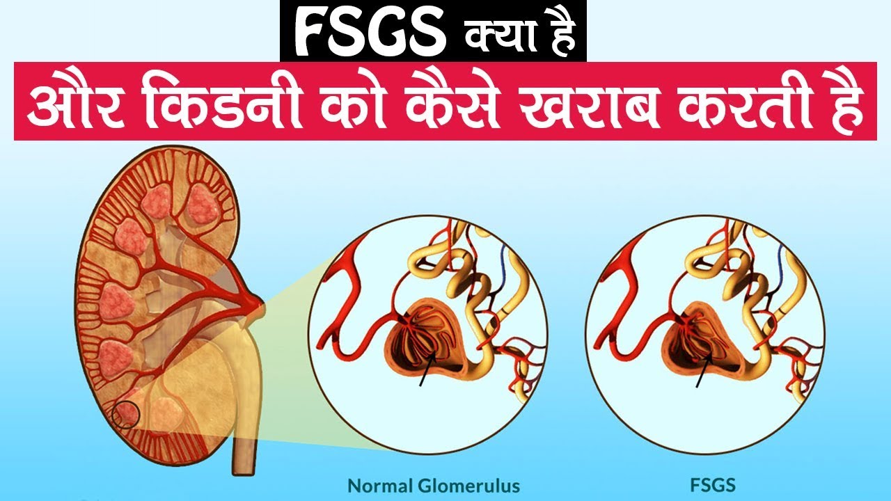 FSGS क्या है और किडनी को कैसे खराब करती है | How FSGS Affects Your ...