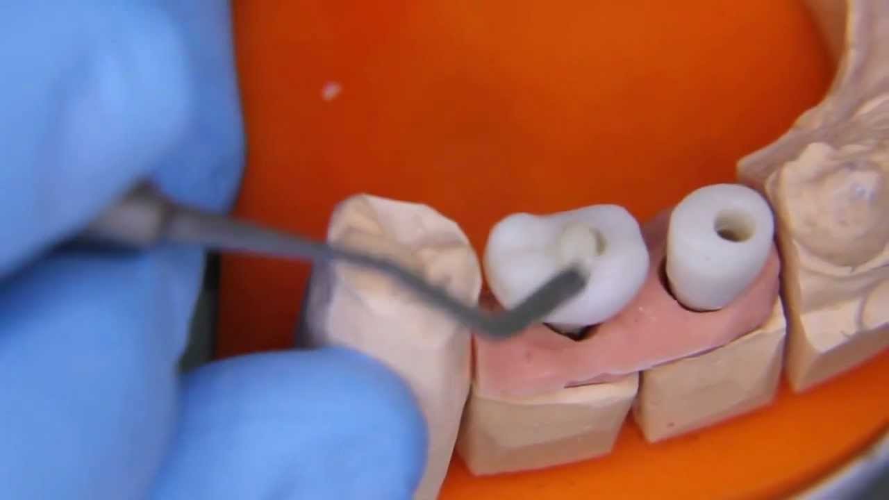 Coroane NobelProcera insurubate pe implanturi NobelBiocare Procera ...