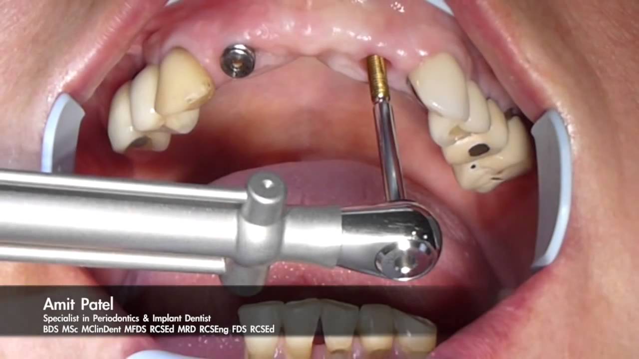 NeoBiotech Fixture Remover Kit - извлечение имплантата (клинический ...