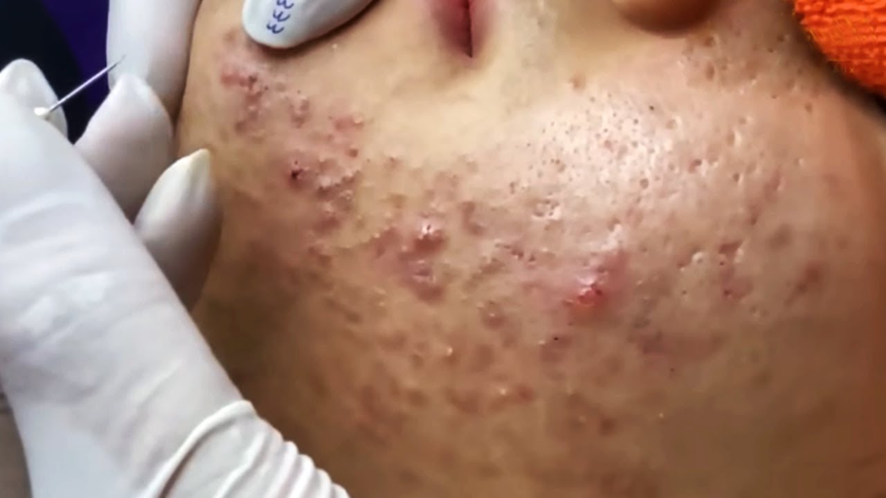 "Satisfying Blackhead & Whitehead Removal! 😲 Pimple Popping | Acne ...