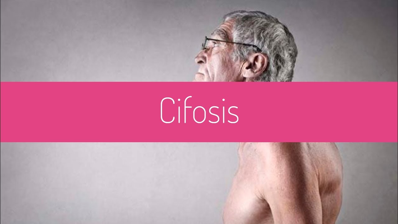 Cifosis: definición, síntomas, causas y tratamientos - YouTube