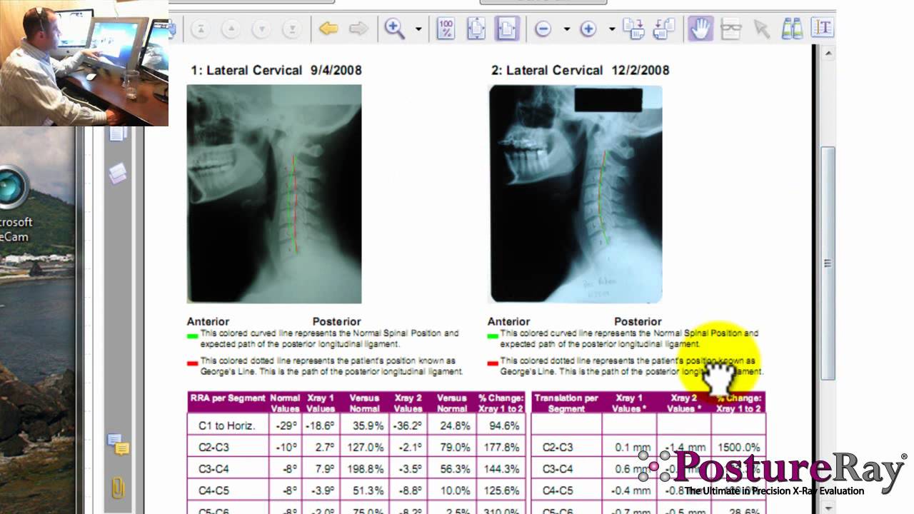 Comparitive X-Ray Reports, Digitized with PostureRay Software - YouTube
