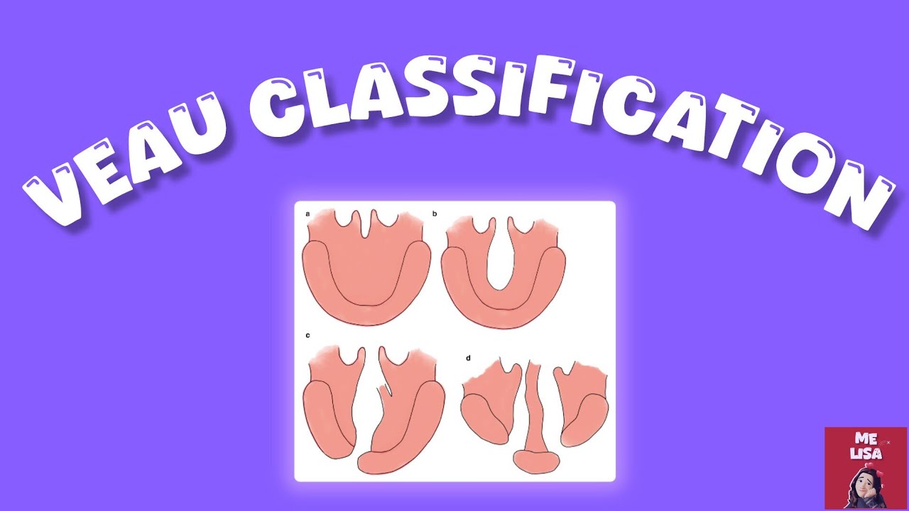Cleft Lip An Palate Classification: VEAU CLASSIFICATION - YouTube