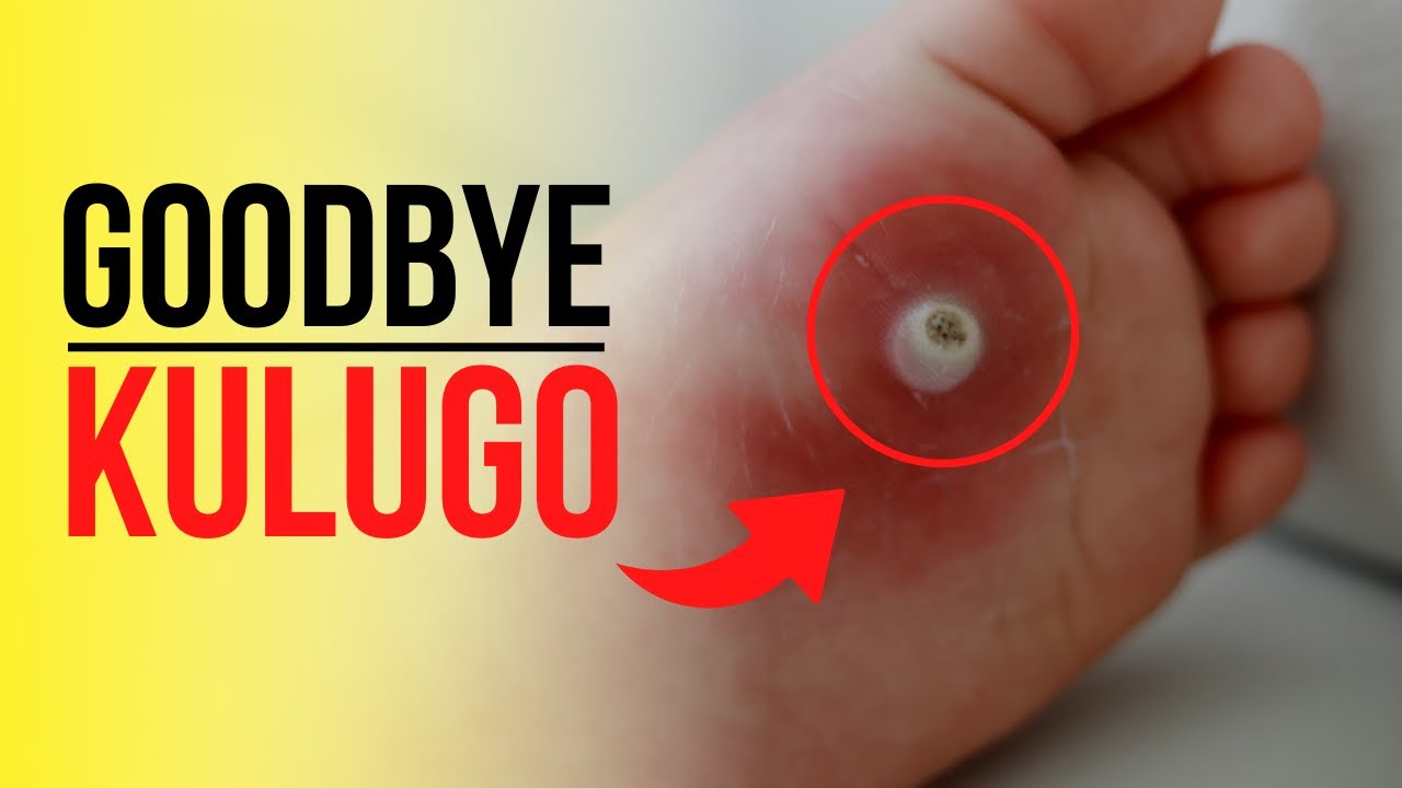 Home & Natural Remedies para sa KULUGO | Effective na gamot sa Kulugo ...