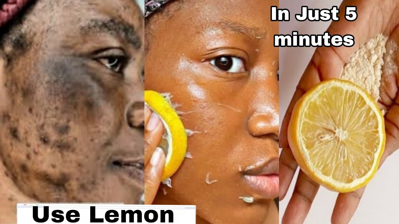 I USE WATER AND LEMON ON MY SKIN, LOOK WHAT IT DID TO MY SKIN!! CLEAR ...