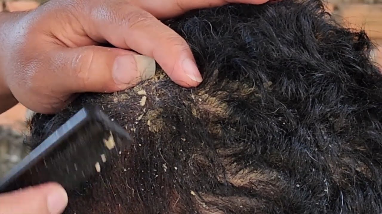 ASMR Scalp Scratching for Sleep and Relaxing Care #469 - YouTube
