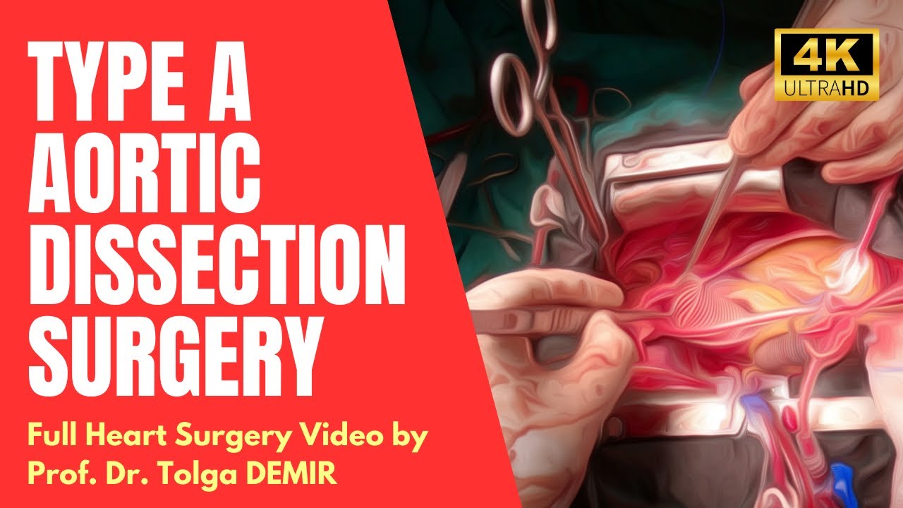 Type 1 Aortic Dissection – Emergency Open Heart Surgery | Real Surgery ...