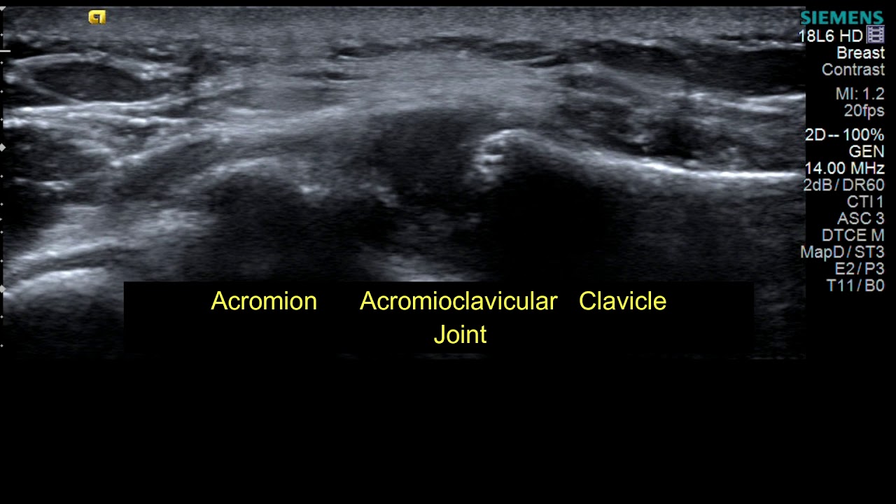 Ultrasound guided Intraarticular Acromioclavicular Joint injection ...