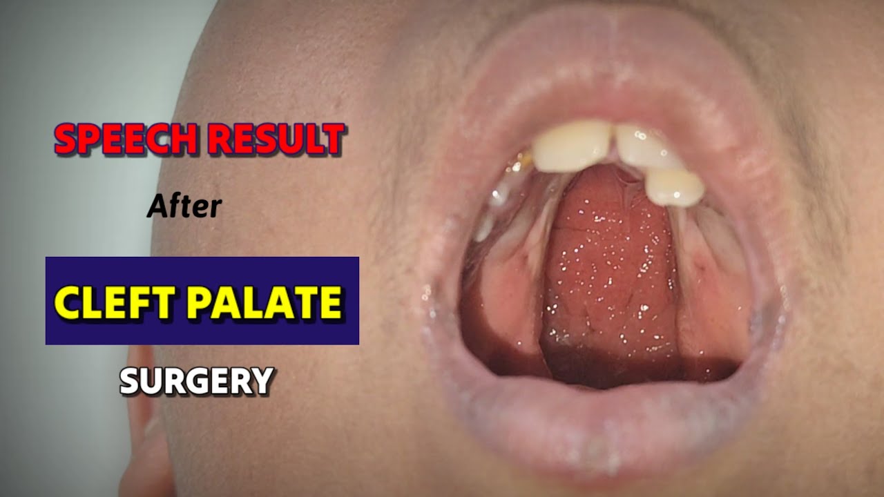 Speech Result After Cleft Palate Surgery | Dr Parit Ladani - YouTube