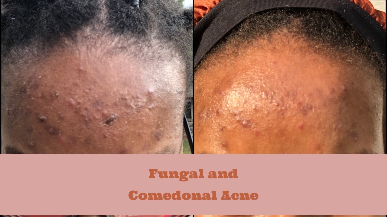 Clearing up my Fungal and Comedonal Forehead Acne?? | Skin Diary ...