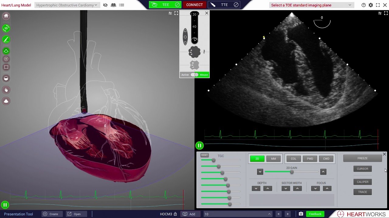 HeartWorks Hypertrophic Cardiomyopathy (TEE) - YouTube