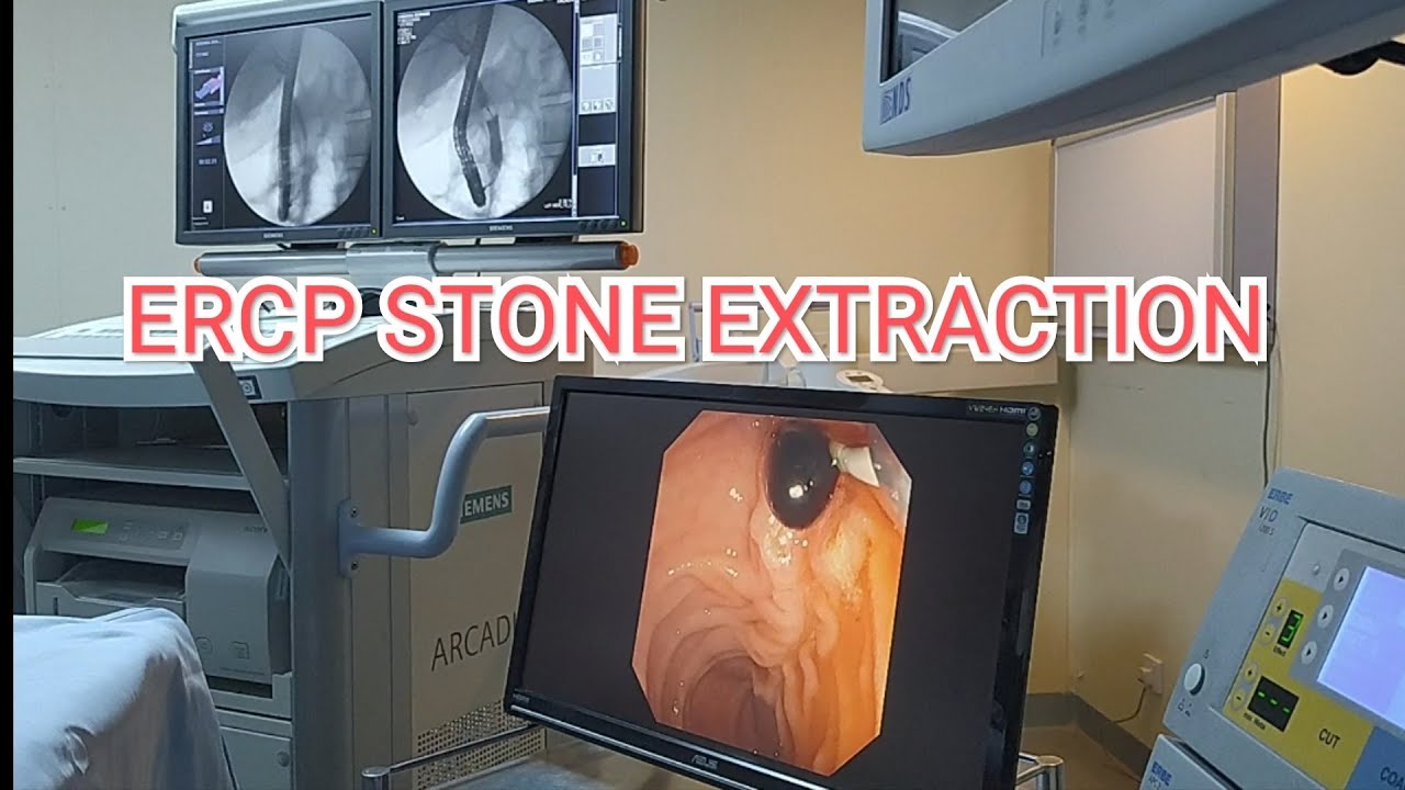 CHOLEDOCHOLITHIASIS ERCP STONE EXTRACTION at SQUARE HOSPITAL LTD Dhaka ...