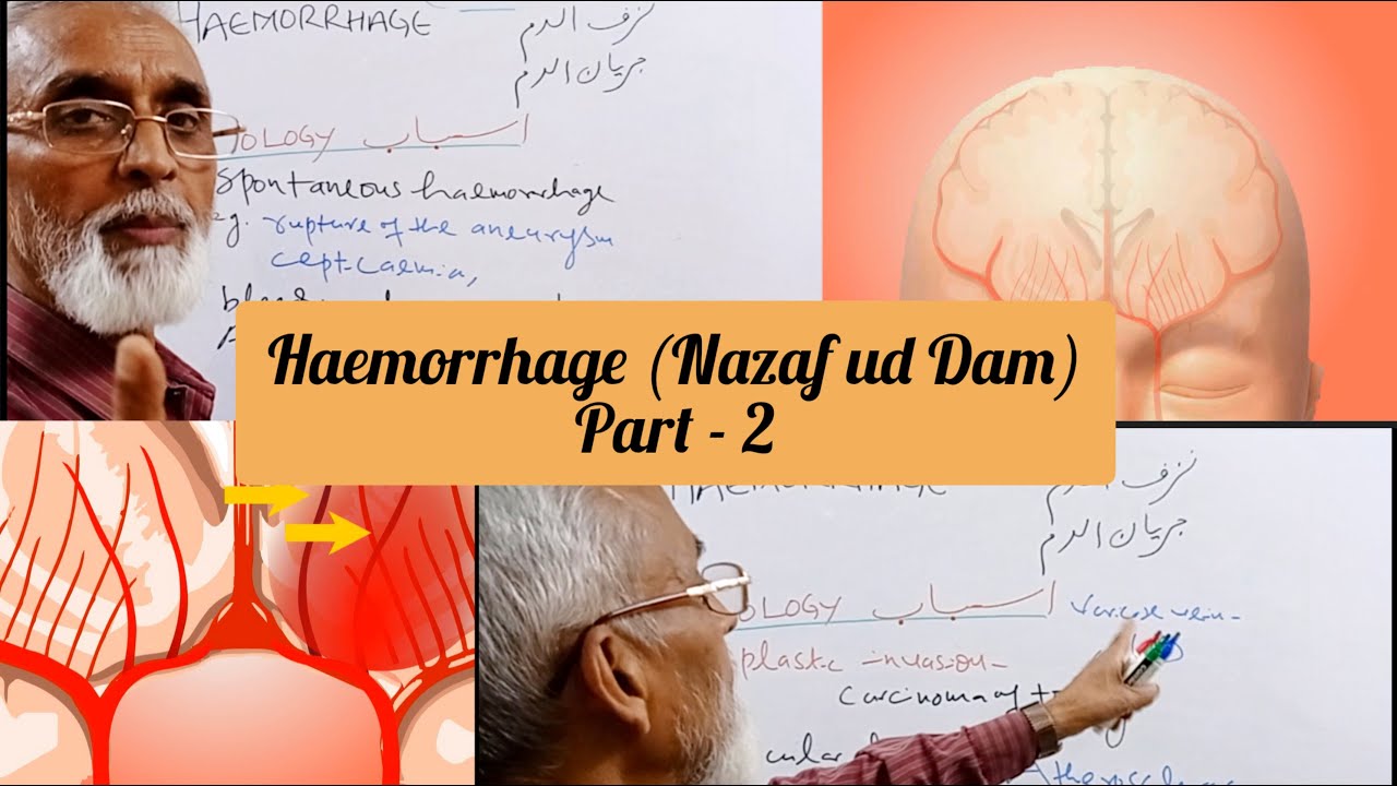 Haemorrhage (Nazaf ud Dam) Part - 2 - YouTube