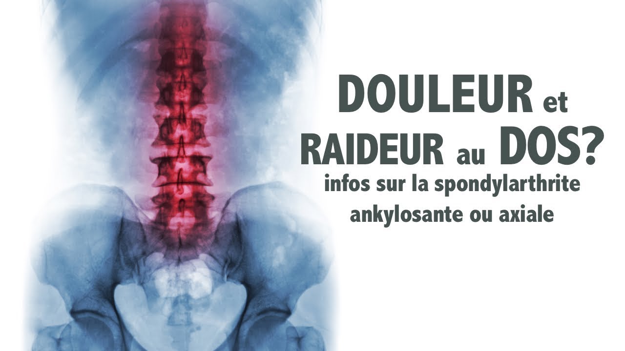 Raideur au dos: info sur la spondylarthrite ankylosante ou axiale - YouTube