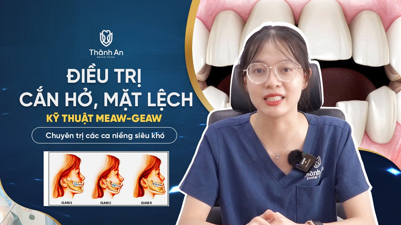 NIỀNG RĂNG KỸ THUẬT MEAW-GEAW ĐIỀU TRỊ CẮN HỞ MẶT LỆCH NHƯ THẾ NÀO ...