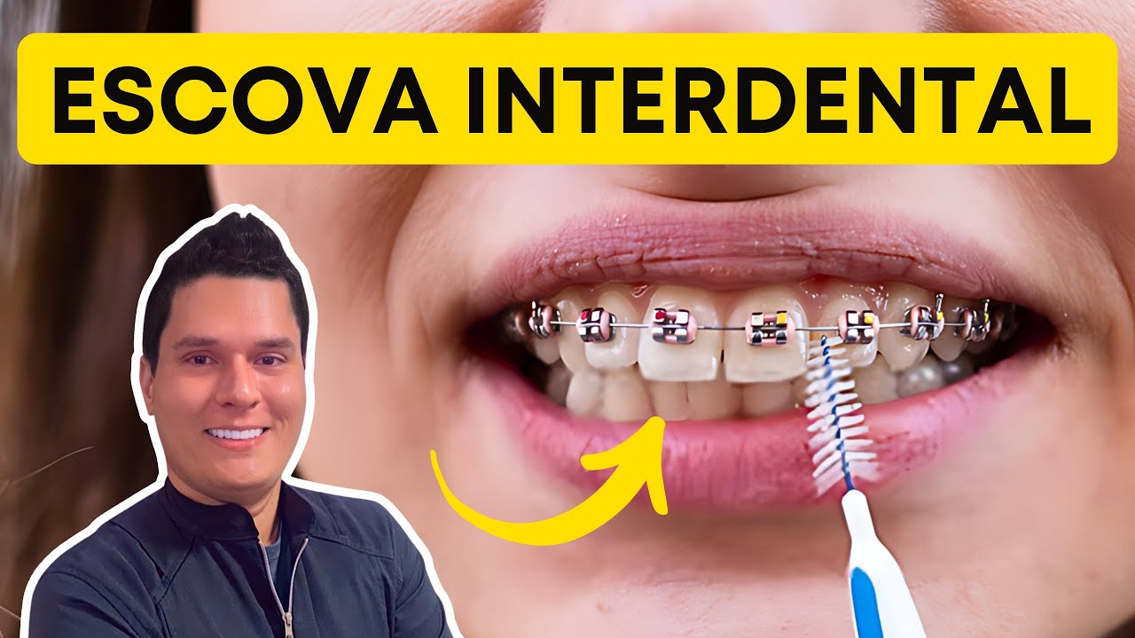 ESCOVA INTERDENTAL : COMO USAR DO JEITO CERTO? (GUIA PRÁTICO). - YouTube