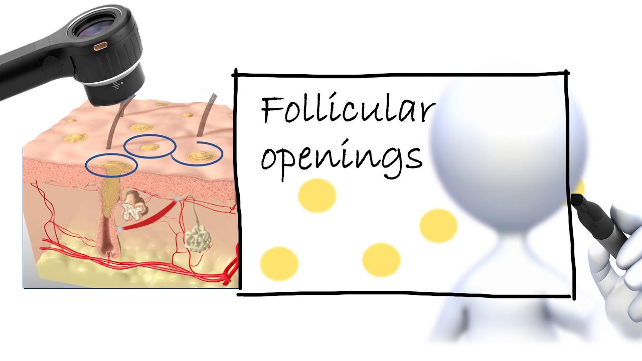 Trichoscopy for beginners (basic hair structures) 2020 - YouTube