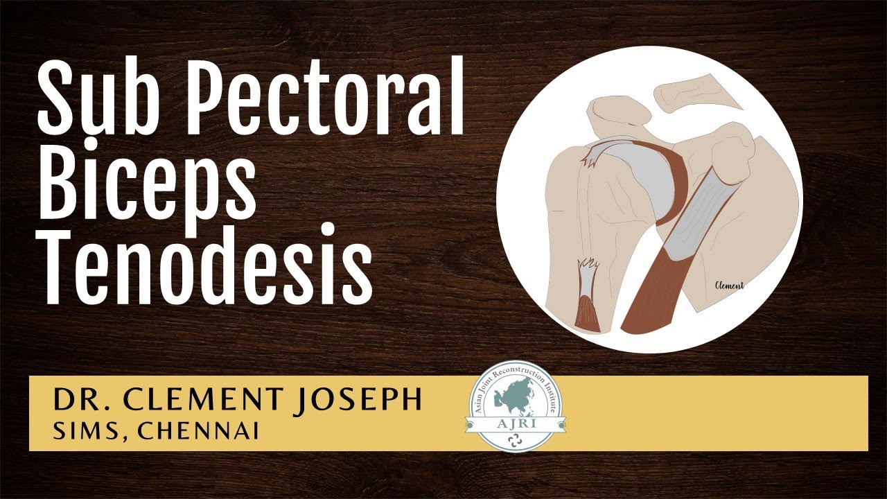Sub pectoral Biceps tenodesis ( open ) - YouTube
