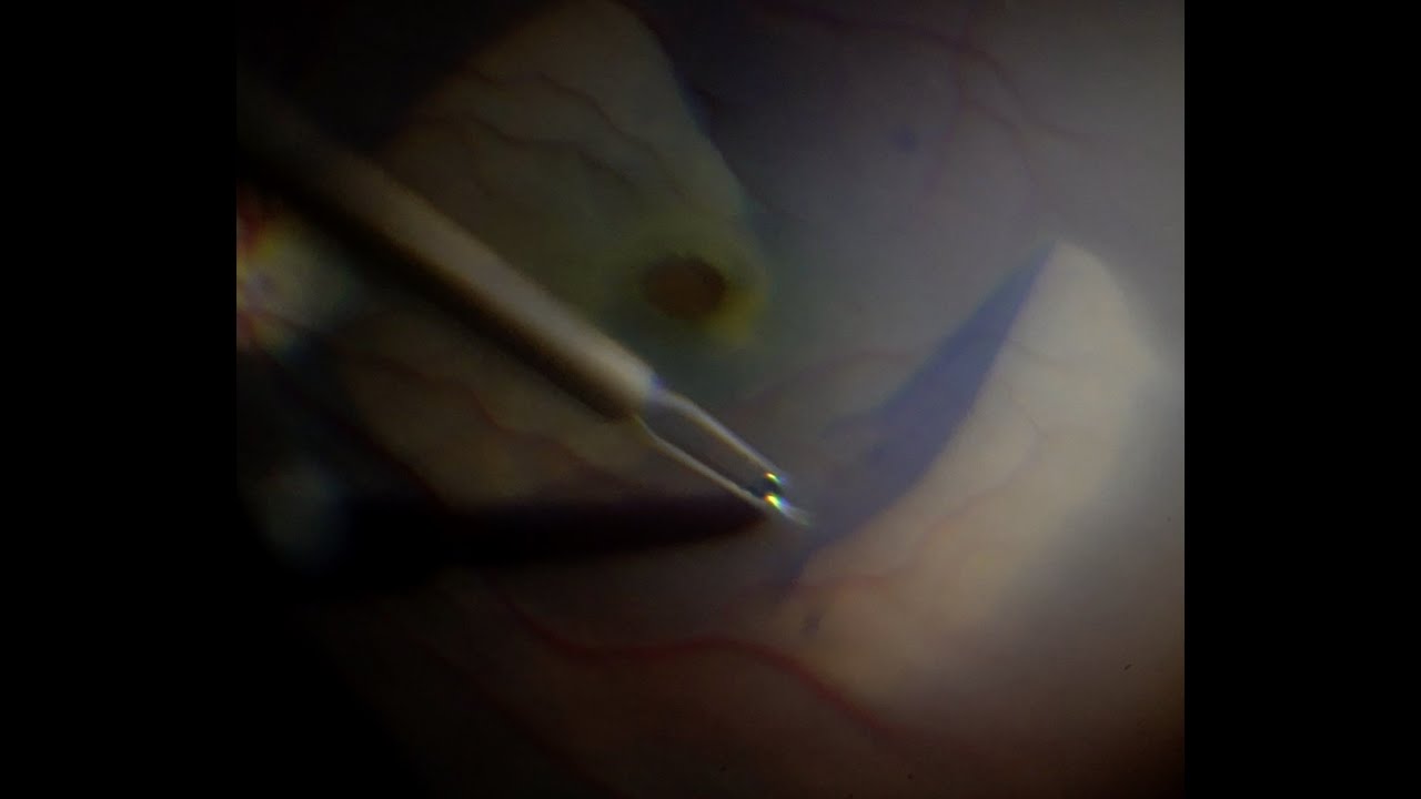 Modified ILM flap technique for macular hole - YouTube