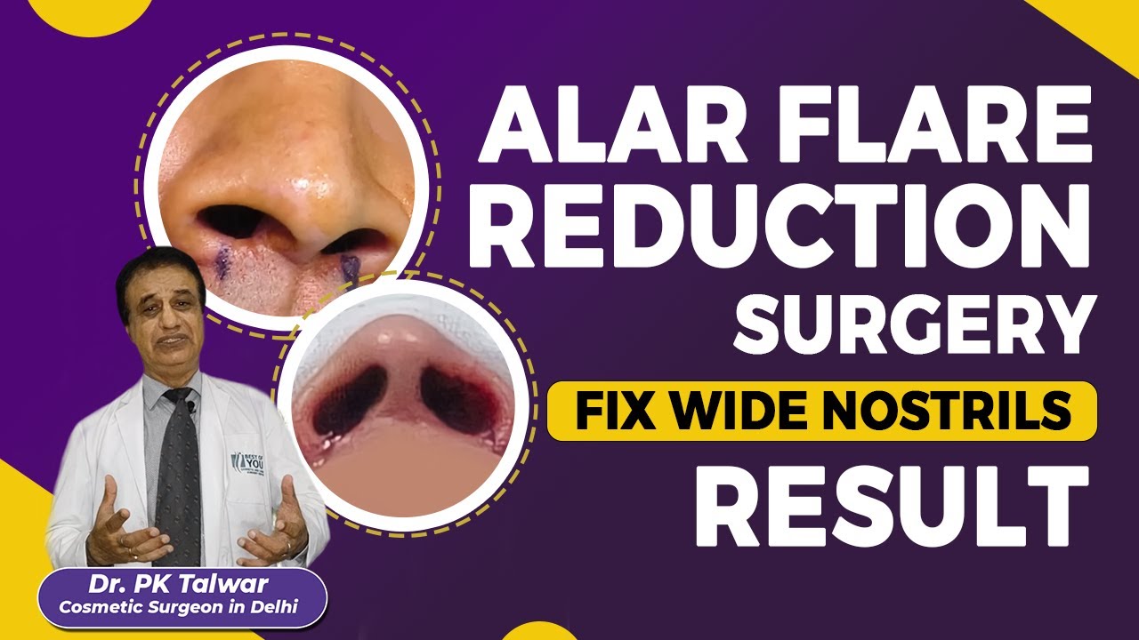 Alar Flare Reduction Surgery l Rhinoplasty Surgery in Delhi l Dr. PK ...