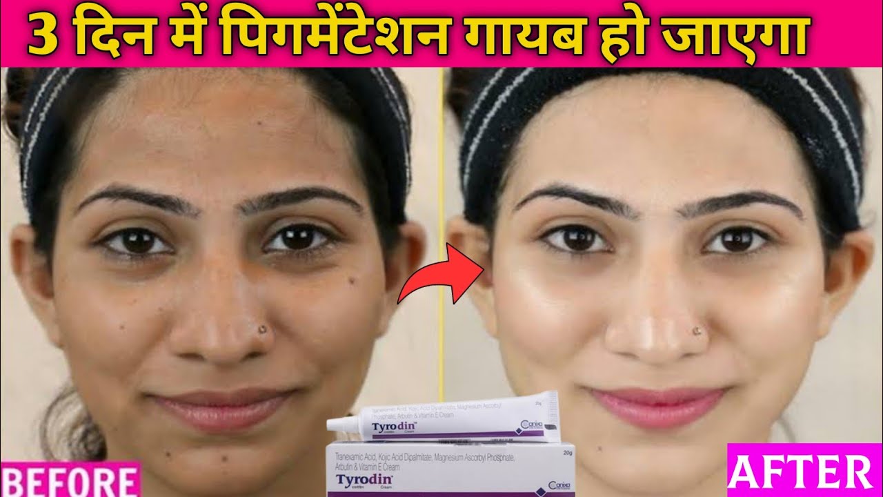 Tyrodin cream review in 2023 | best cream for Pigmentation? - YouTube