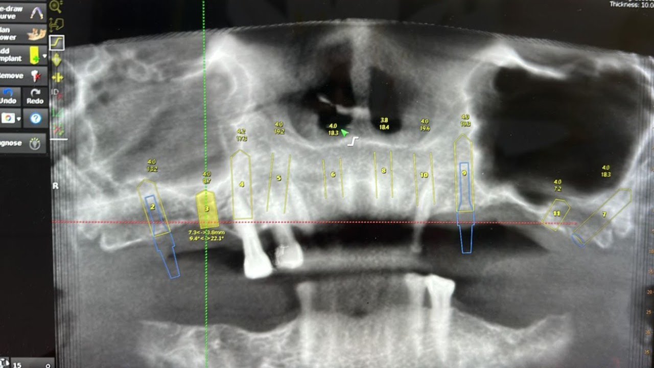 upper maxillary teeth extraction and replacement with bioline implants ...