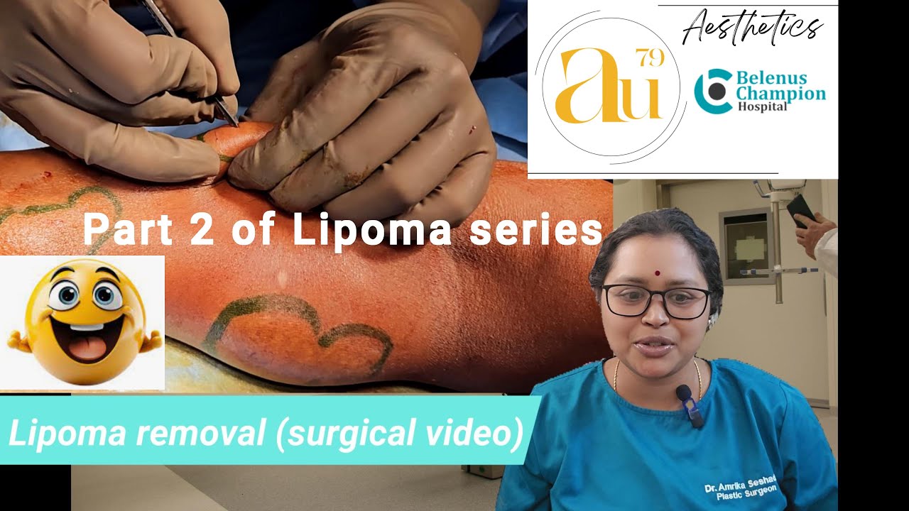 Lipoma removal surgery - YouTube