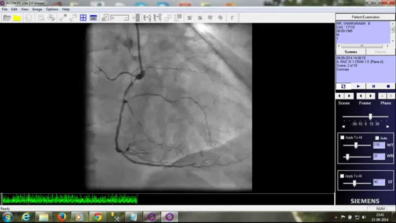Angiogram Report - YouTube