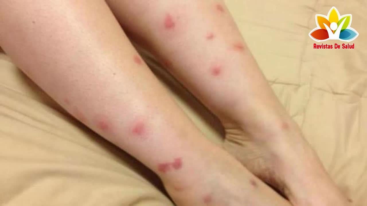 Aprende a curar las picaduras de mosquitos de una manera efectiva - YouTube