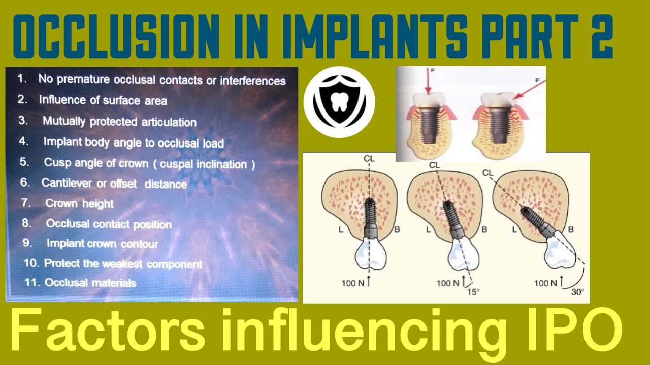 Occlusion in Implants part 2 - YouTube