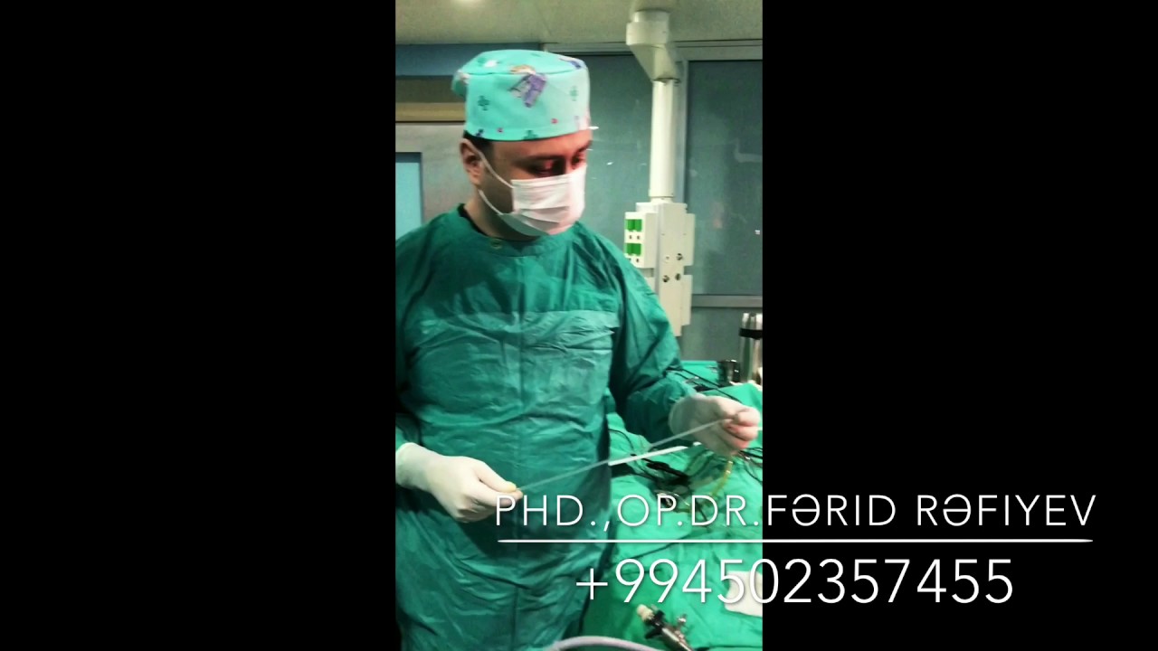 Kəskin appendisit. Əməliyyat izahı - YouTube