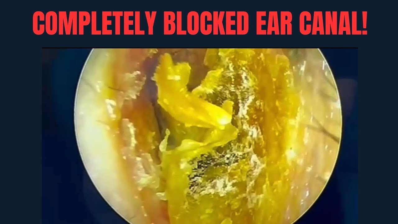 COMPLETELY BLOCKED EARWAX REMOVAL! Professional Ear Cleaning! Super ...