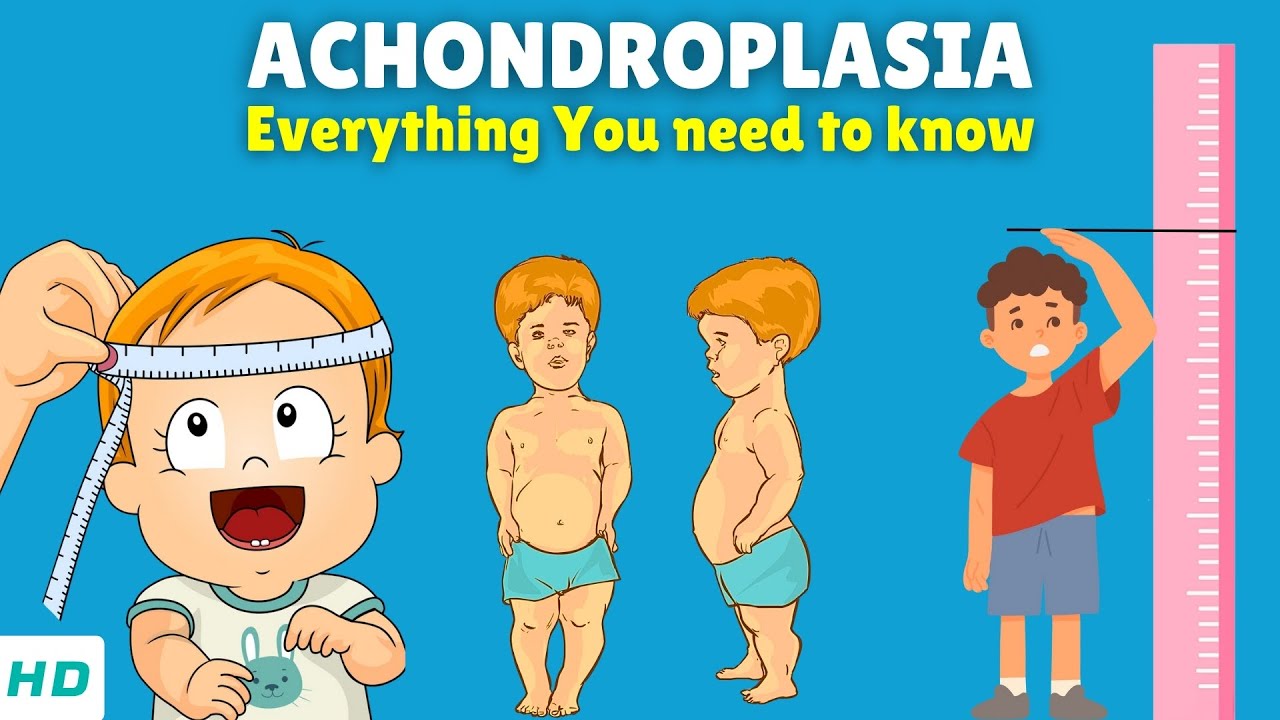 Achondroplasia In Babies: Signs And Symptoms – WATQVT