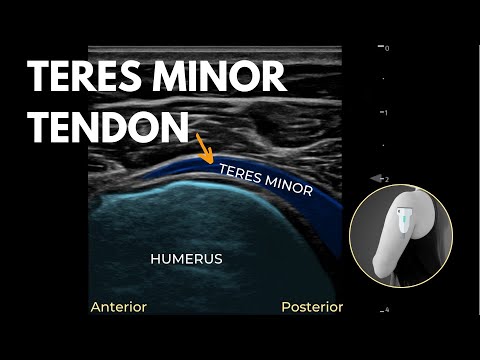 Shoulder Teres Minor Tendon– MSK Ultrasound Snapshot