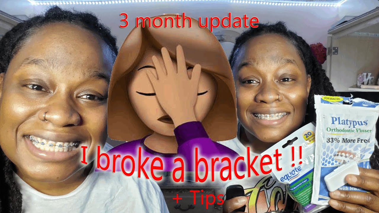 I BROKE A BRACKET 🥴 !? + TIPS on Hygiene | Adult Braces Vlog 2 ...