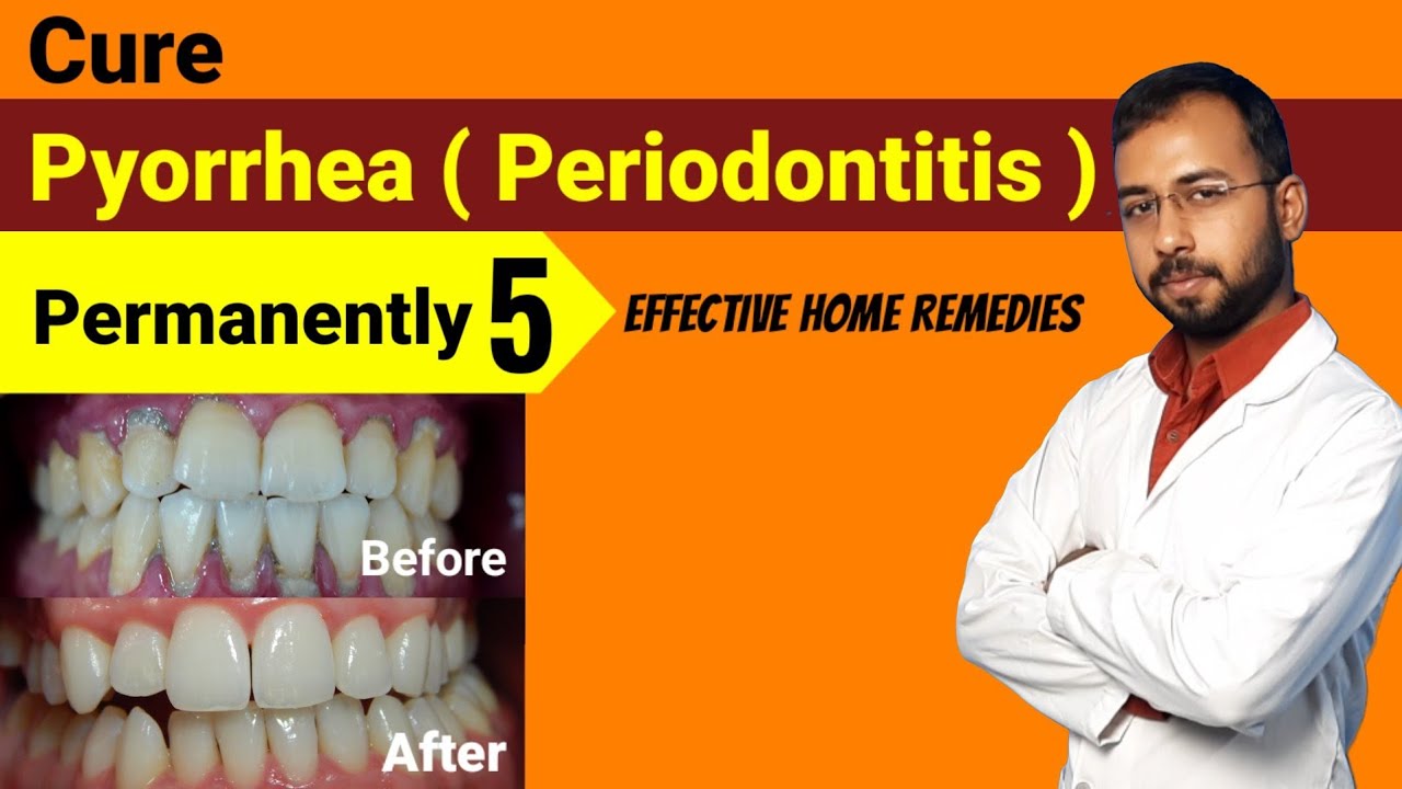 Pyorrhea treatment at home | pyorrhea home remedies | Periodontitis ...