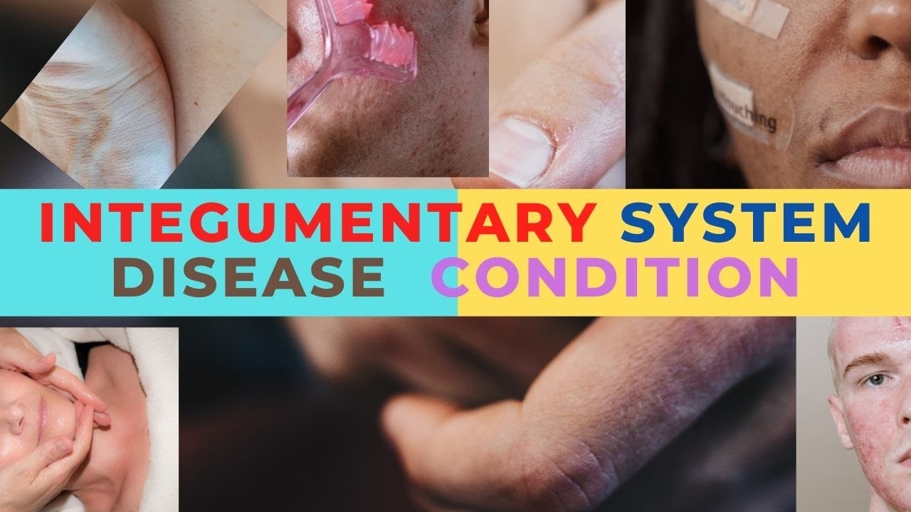 Integumentary System Disease Conditions Part-II Burns / dryness of skin ...
