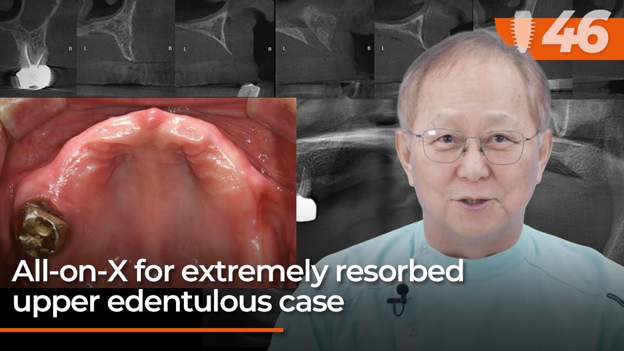 [Preview] All-on-X for extremely resorbed upper edentulous case - YouTube