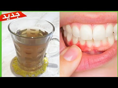 أقسم بالله علاج التهابات اللثة من اول يوم استعمال👍👍/علاج التهاب اللثة وانتفاخها في المنزل