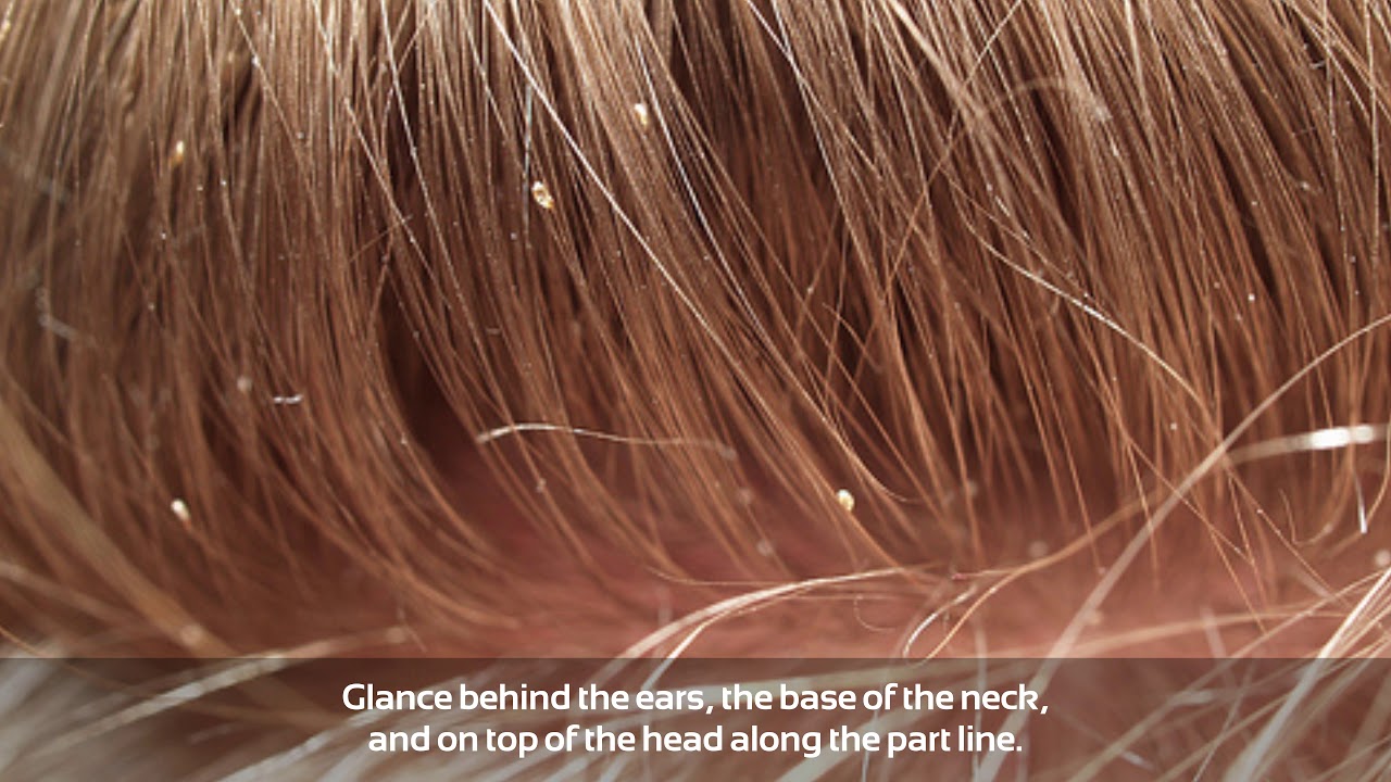 HOW TO SERIES: Proper Maintenance to Ensure the Lice DO NOT Return ...