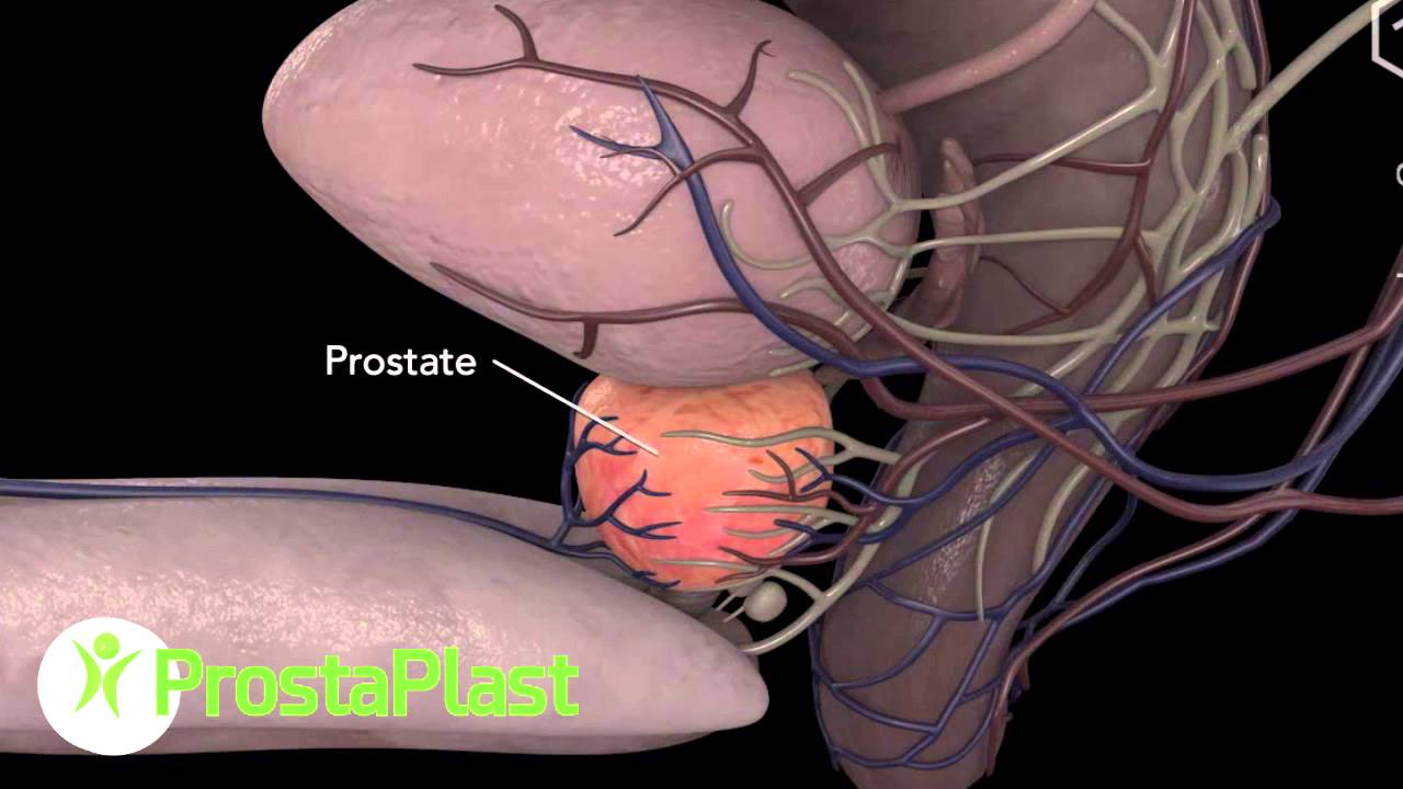 ProstaPlast - Prostate plasters for male health and potency - YouTube