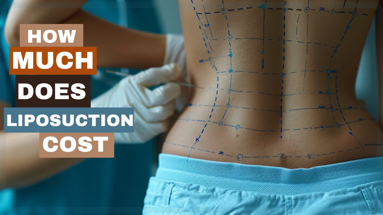 How Much Does Liposuction Cost - YouTube