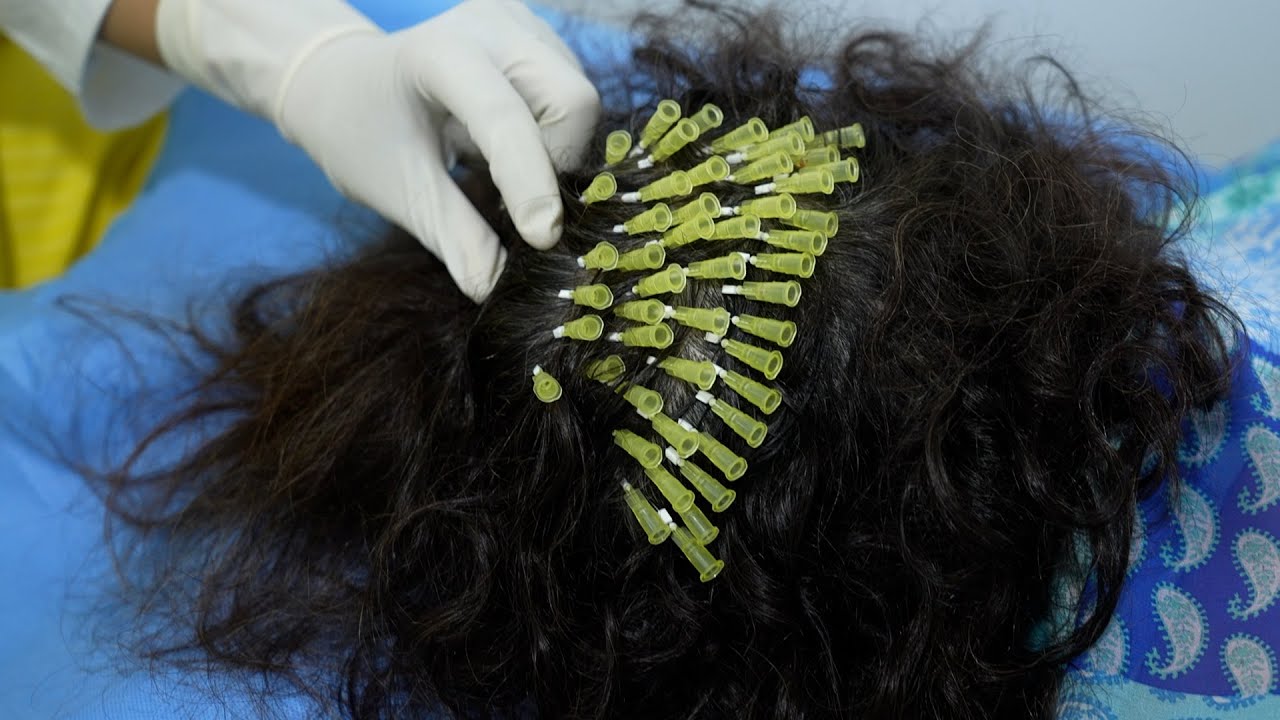 Scalp Collagen Threads for Hair Regrowth - YouTube