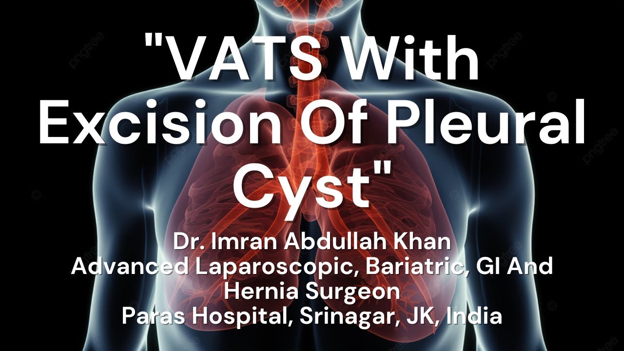 VATS Pleural Cystectomy | Thoracoscopic Pleural Cystectomy| Dr. Imran ...
