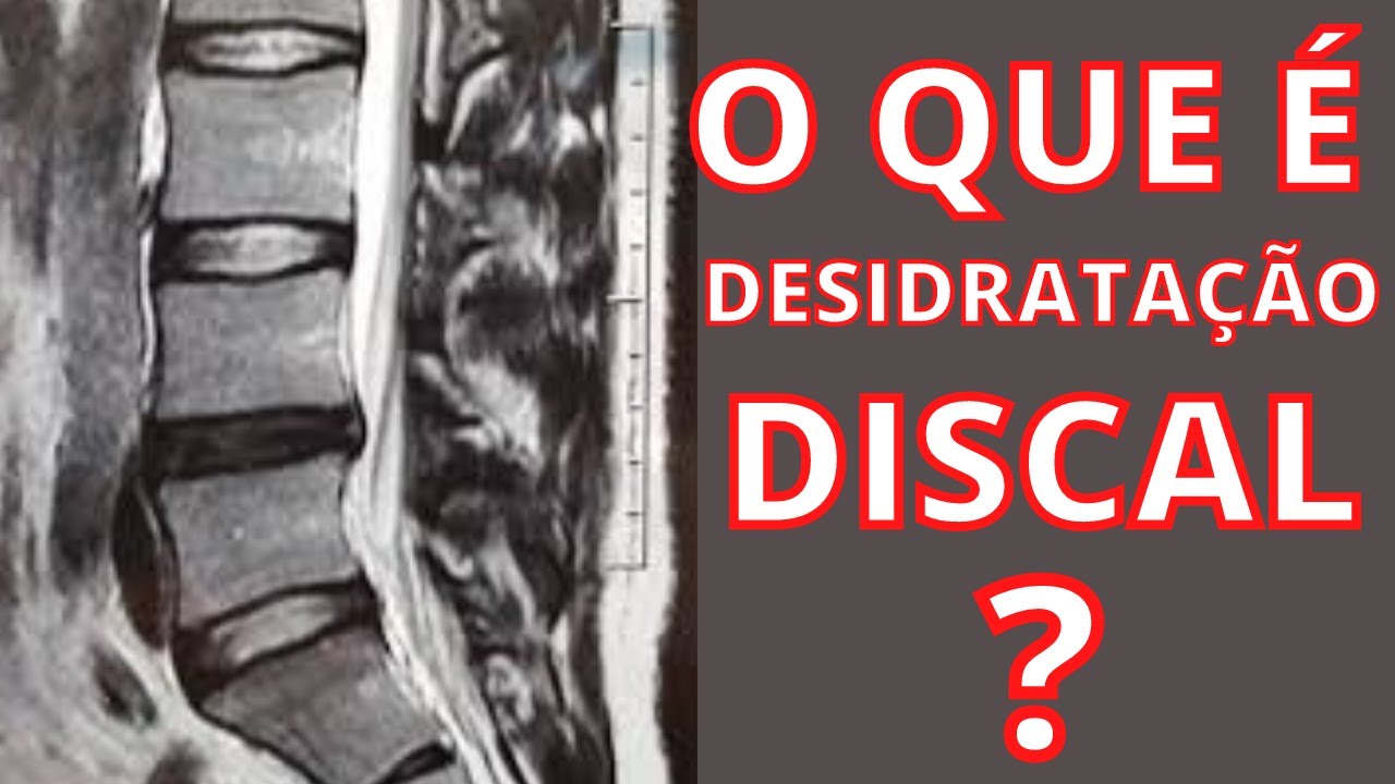 Desidratação Discal L5 S1 - RETOEDU