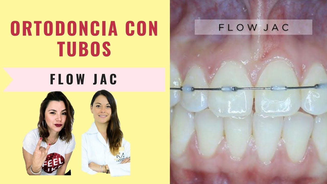 Ortodoncia SIN brackets - OMG Ahora con Tubos?? Flowjac - YouTube