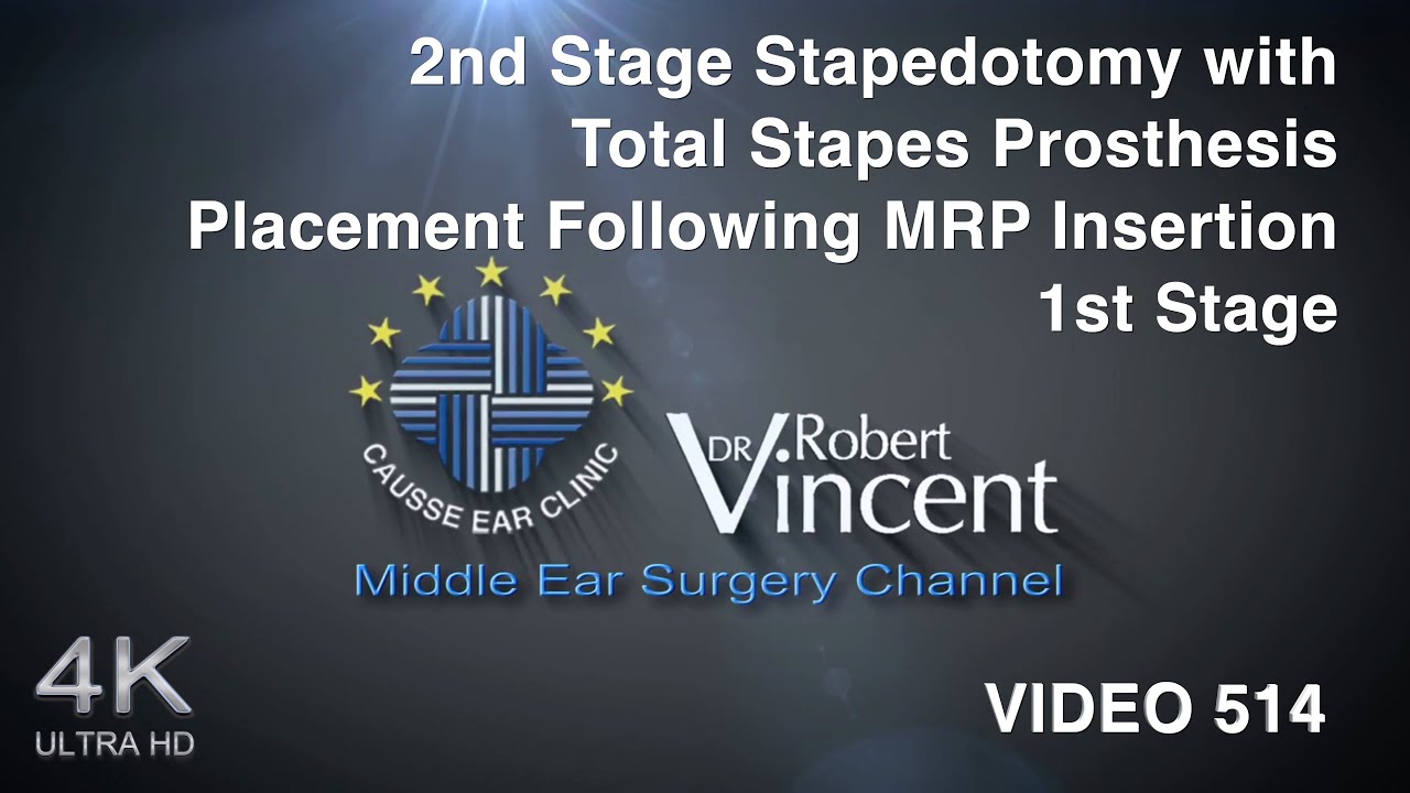 2nd Stage Stapedotomy with Malleus Replacement Prosthesis-to ...