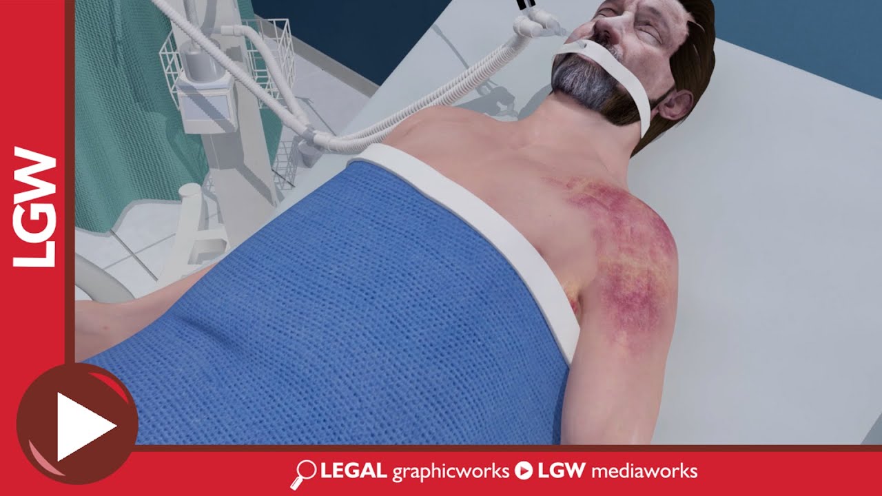 Injury Summary 3D Animation - YouTube