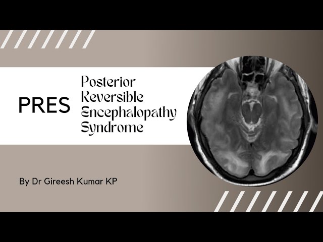 Posterior Reversible Encephalopathy Syndrome Pres Pediatric Posterior